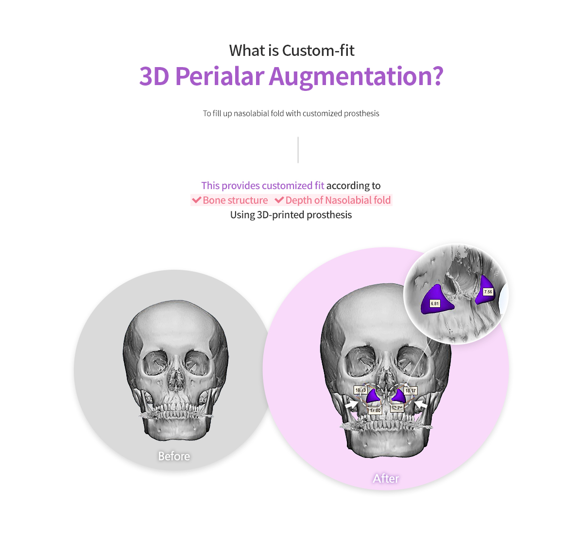 Custom prosthesis Perialar augmentaion - GNG Hospital, Plastic surgery ...