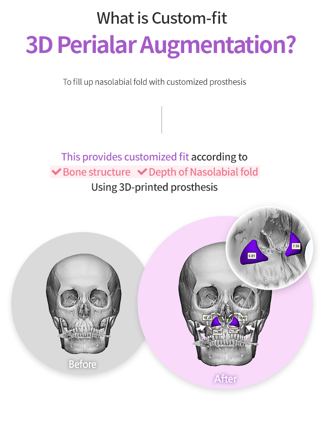 Custom prosthesis Perialar augmentaion - GNG Hospital, Plastic surgery ...