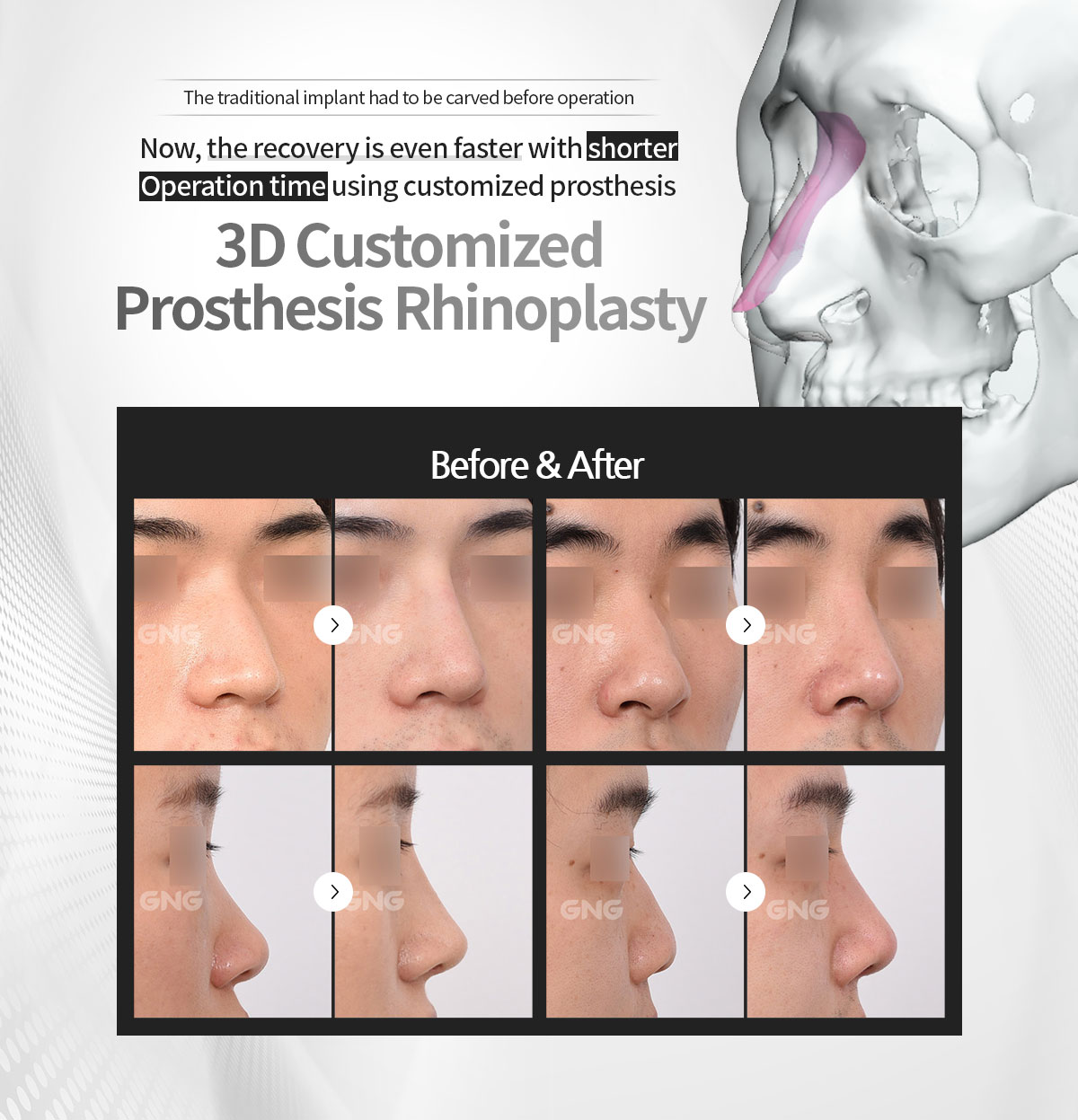 3D custom silicone - GNG Hospital, Plastic surgery, ENT.