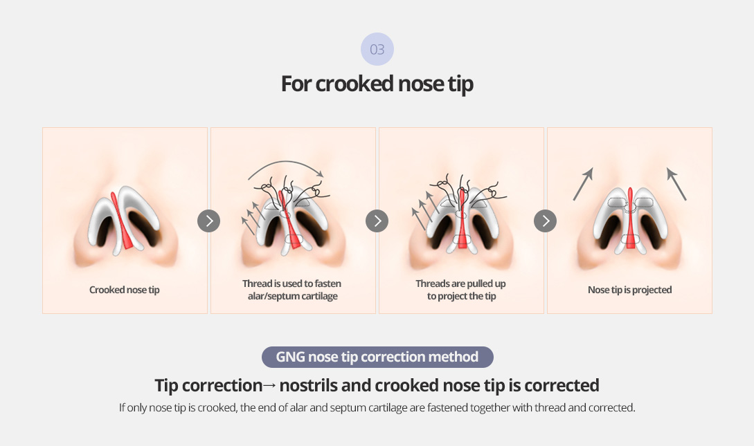 Deviated-nose, Rhinitis, Clogged nose, Deviated nasal septum - GNG ...