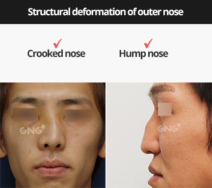 Nasal Fracture Repair, Nasal Bone Fracture - GNG Hospital, Plastic ...