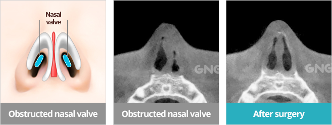 Rhinitis, Turbinate ypertrophy - GNG Hospital, Plastic surgery, ENT.