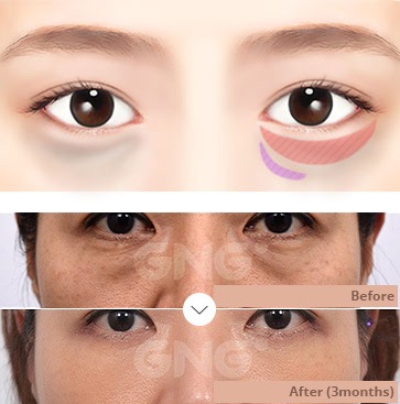 Uder eyelid fat graft, Fat graft, Bags under eye, Fat repositioning ...