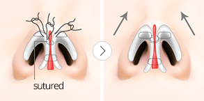Broad nose, Low-bridged nose - GNG Hospital, Plastic surgery, ENT.