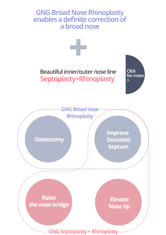 Broad nose, Low-bridged nose - GNG Hospital, Plastic surgery, ENT.